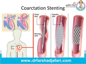 کوآرکتاسیون آئورت(Coarctation of the Aorta-CoA) – دکتر فرشاد جعفری|فوق ...